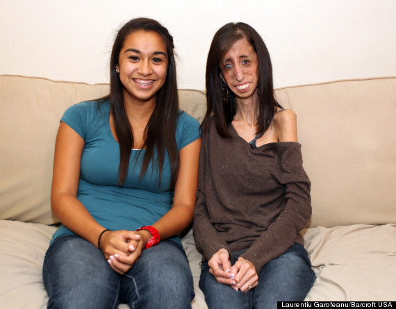 World's Thinnest Woman Lizzie Velasquez Who Has A Medical Condition ...