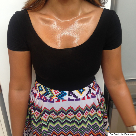 Woman With Hyperhidrosis, An Excessive Sweating Condition, On The ...