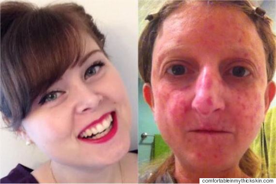 Woman With Scleroderma, A Rare Skin Disease, Describes 'Emotional Blow ...