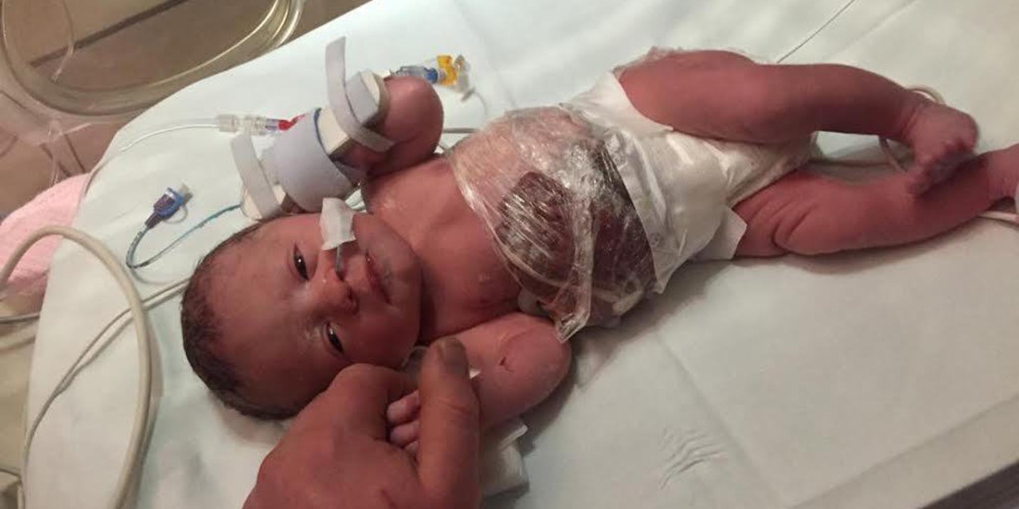 Baby Born With Organs Outside Body Saved By Doctors Who Wrapped Her In ...