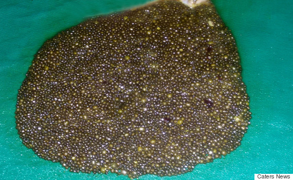 A New (Painful) World Record? Woman Has 12,000 Gallstones Removed In ...